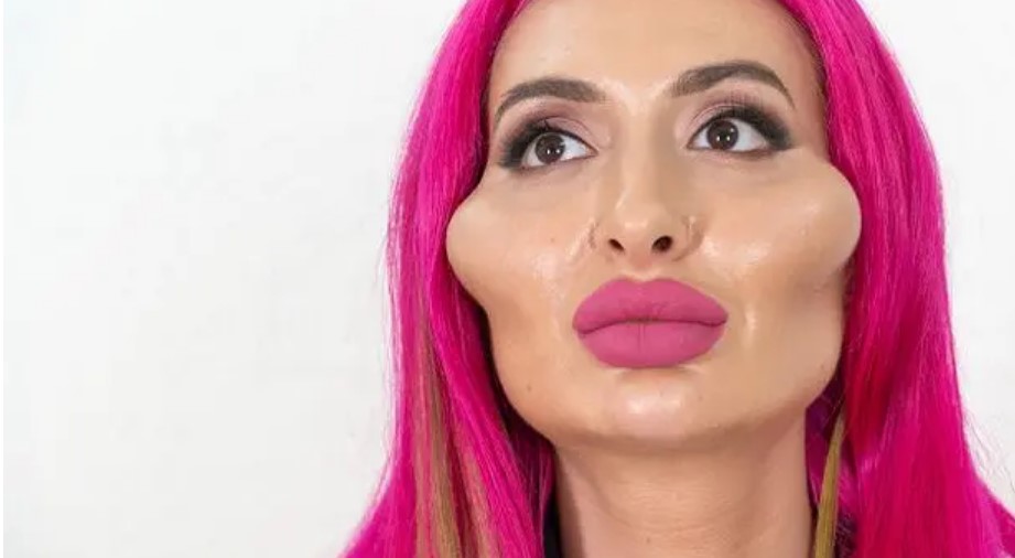 Model With ‘world’s Biggest Cheeks’ Gets Face Filler To Make Look Even ...