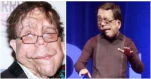 The Extraordinary Life Of Adam Pearson: The Actor With A Genetic ...