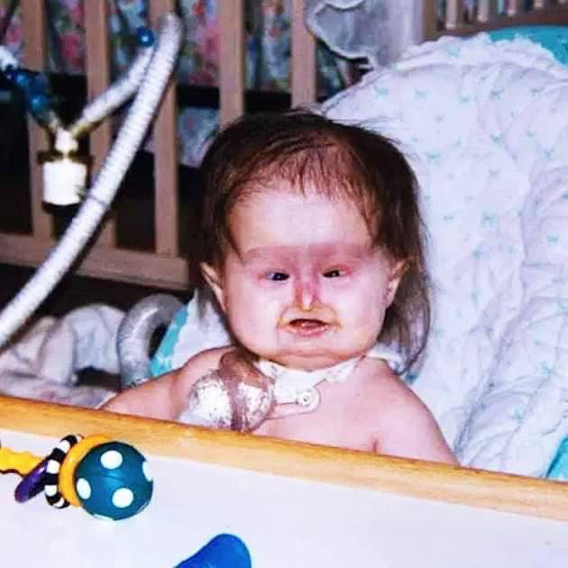Baby Born With Unusual Syndrome – 22 Years Later She Looks Amazing ...