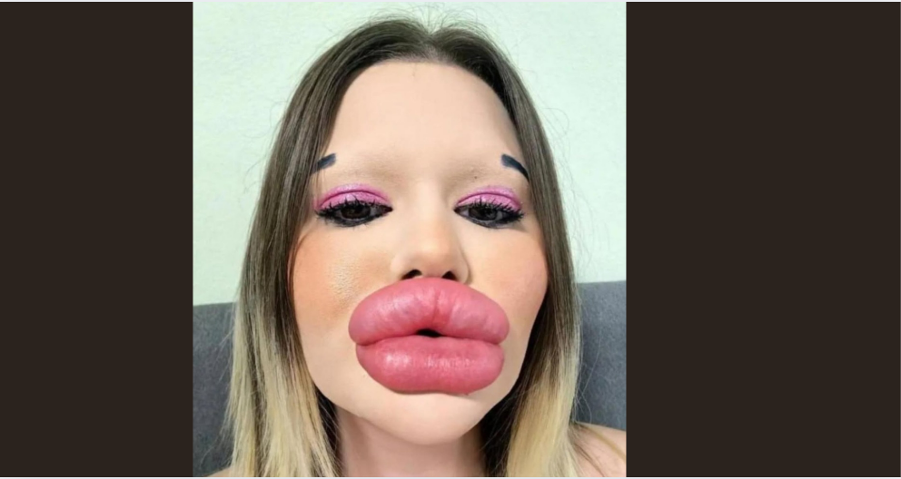 The Individual Boasting The Largest Lips On The Planet! • Writical